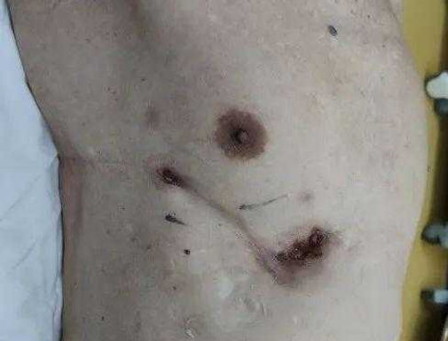 Recognizing Early Signs of Chest Wall Inflammation – ecirclee